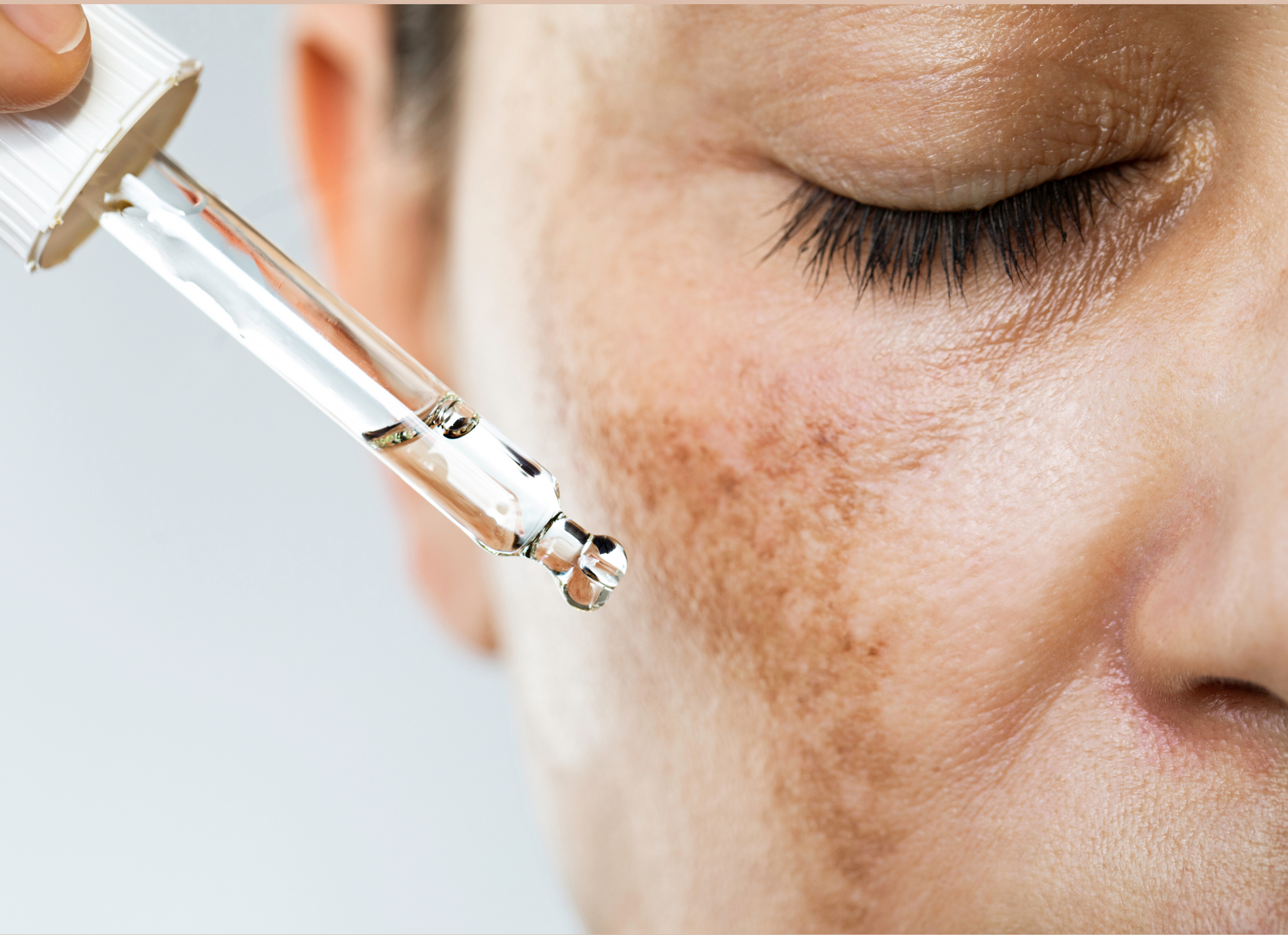 Hyperpigmentation - what are the types? – Rock Melan